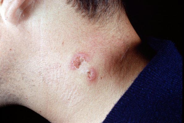 PICT0008 | Elastosis perforans serpiginosa | Dr. Ken Hashimoto | Wayne State University SOM ...